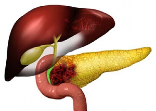 Kanceri i pankreasit, çfarë duhet të dini për këtë "vrasës dinak ...